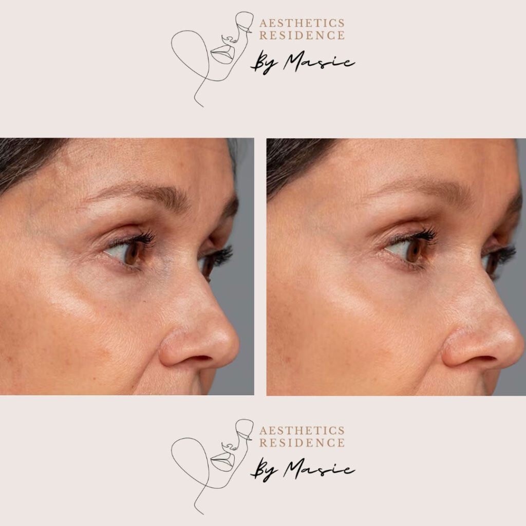 Erbium Laser Sydney | Erbium Laser Resurfacing