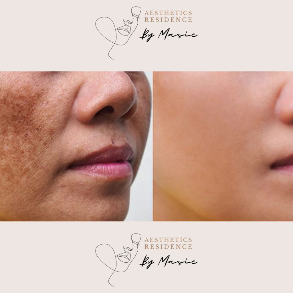Skin Pigmentation, Age Spots & Melasma - Aesthetics Residence by Masie
