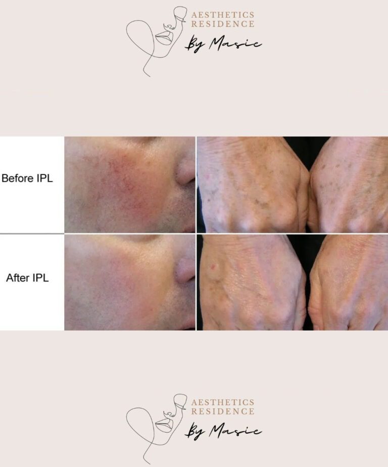 IPL Laser Sydney | Aesthetics Residence by Masie